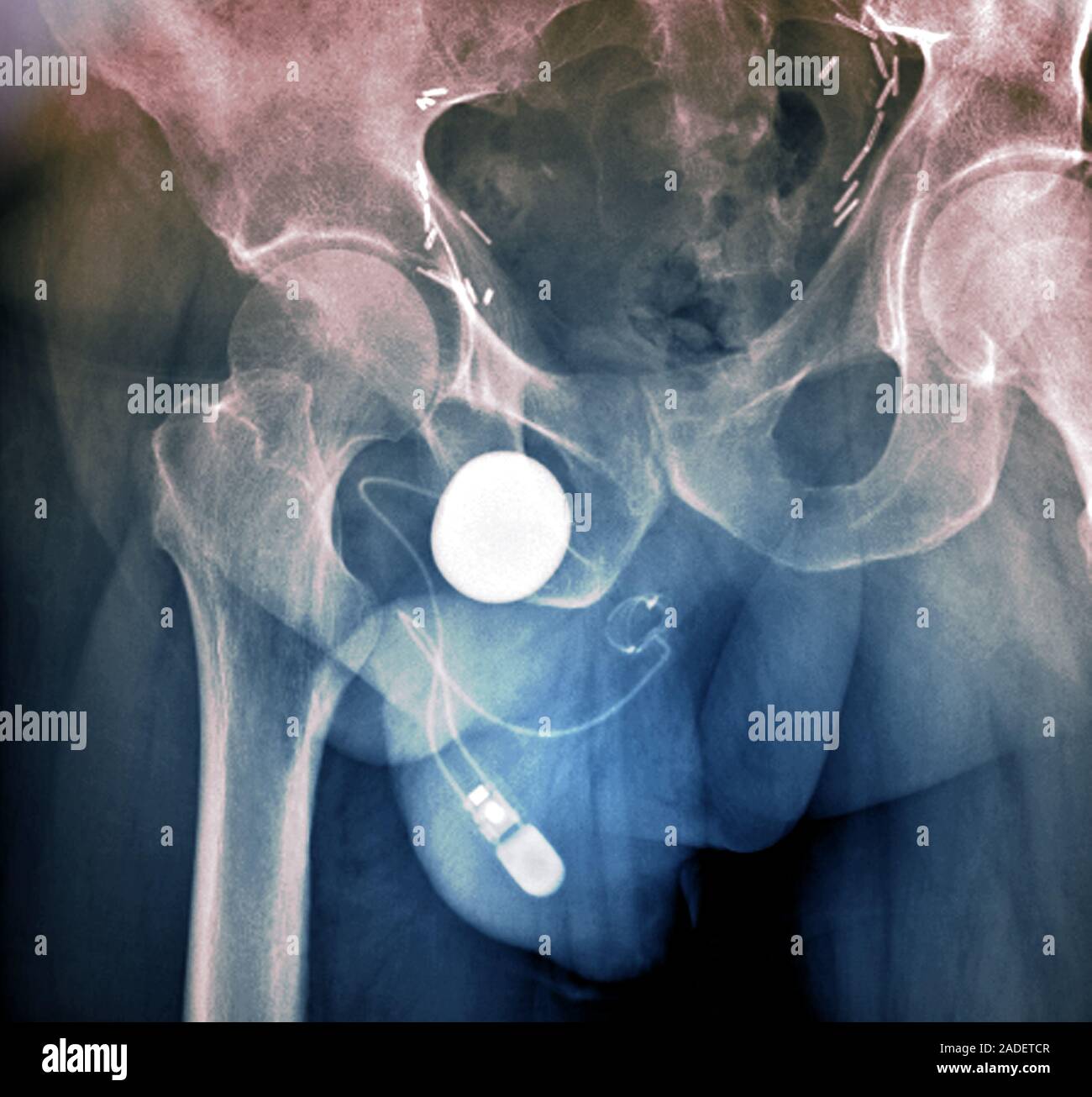Incontinence implant. Coloured X-ray of a section through the pelvis of ...