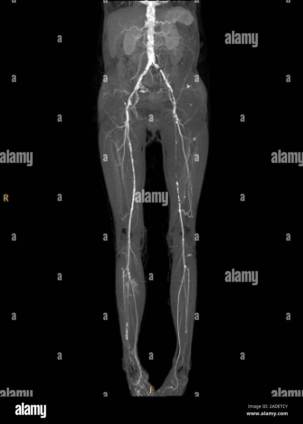 Vascular disease. Computed tomography (CT) angiogram of the abdominal ...