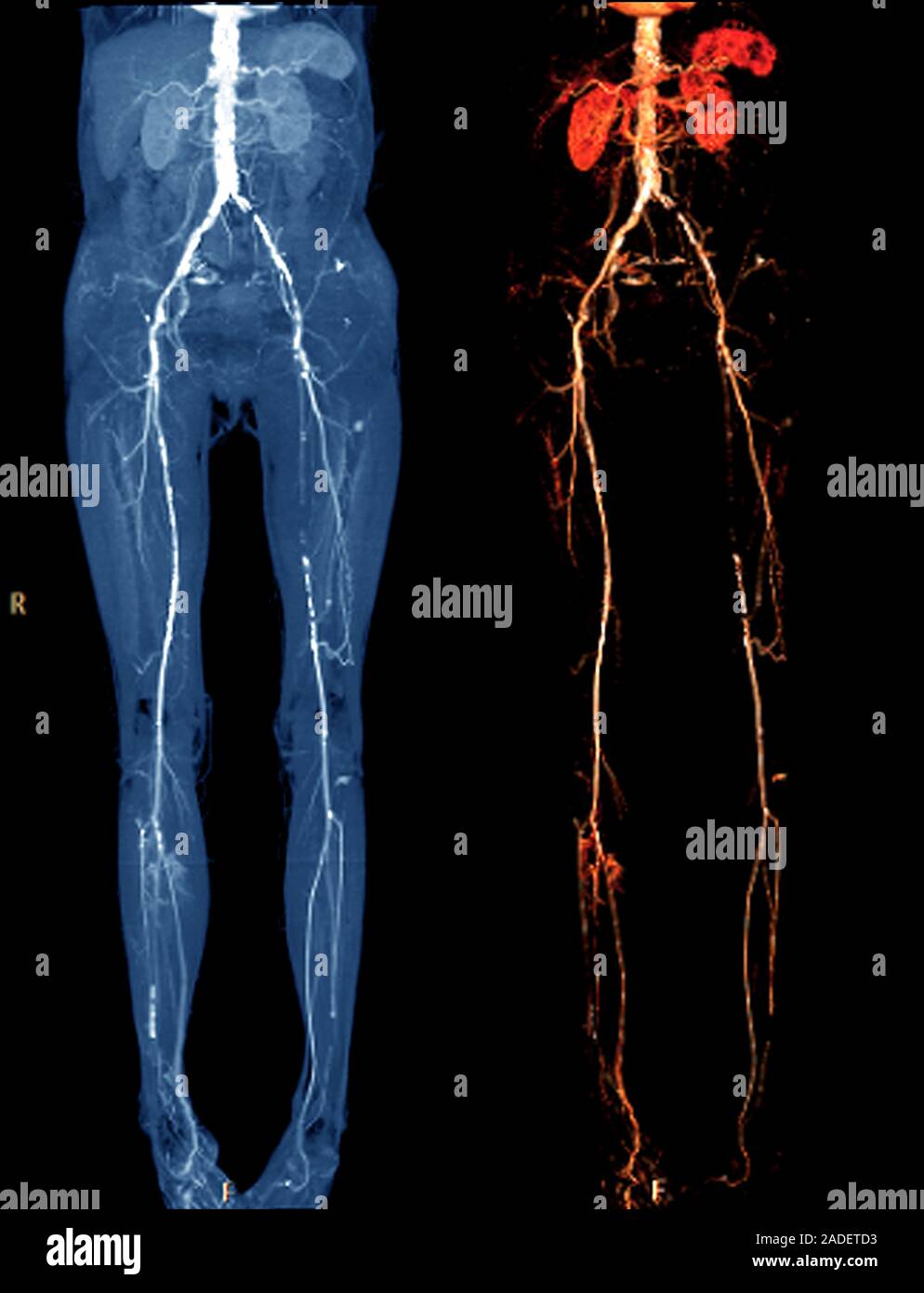 Vascular disease. Coloured 2D (left) and 3D (right) computed tomography ...