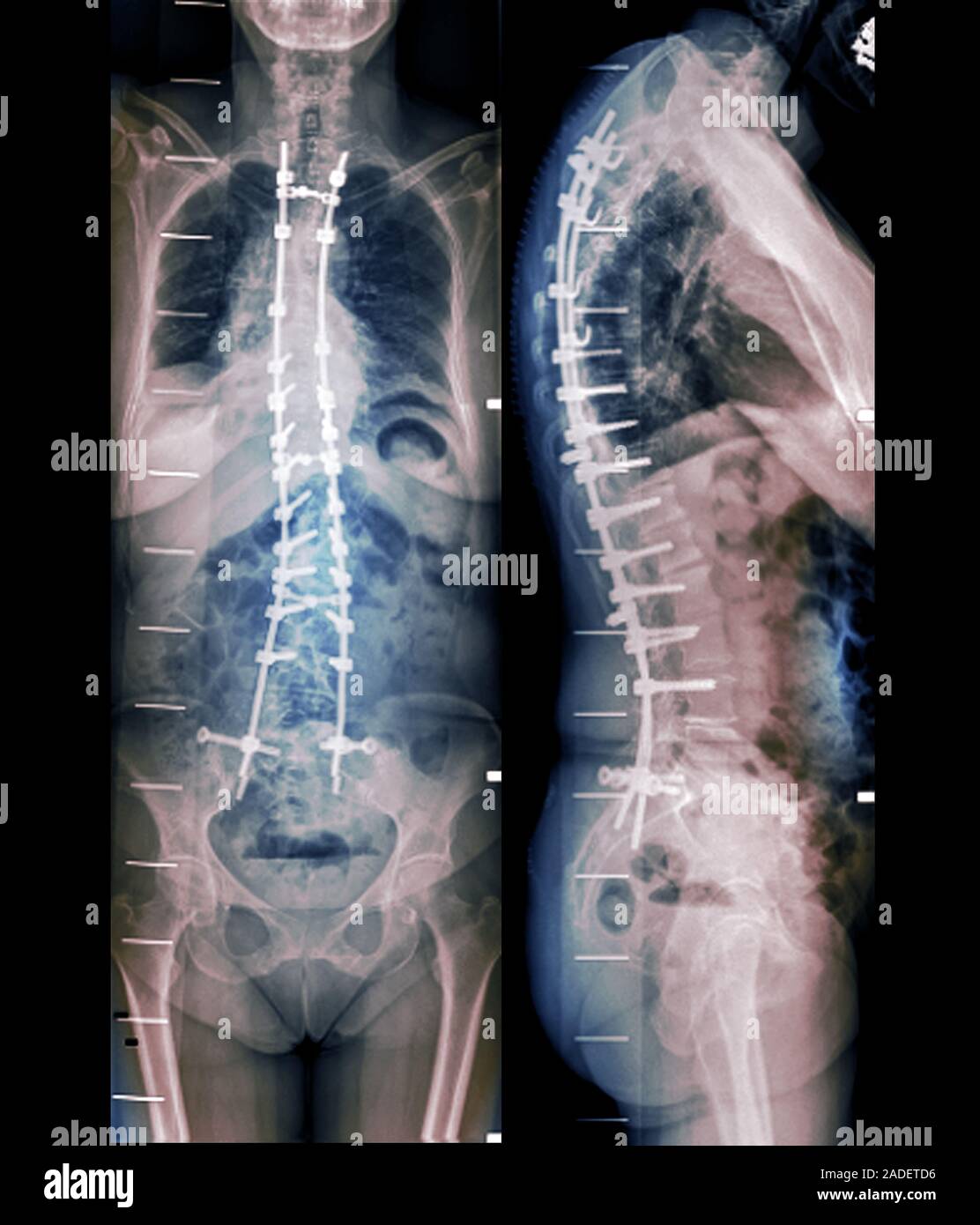 Corrected spine in osteoarthritis. Coloured X-rays showing frontal ...