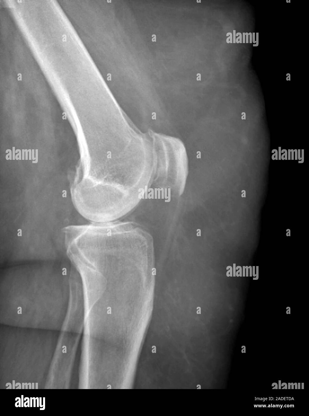 Osteoarthritis of the knee in obesity. X-ray of the left knee of a 49 ...