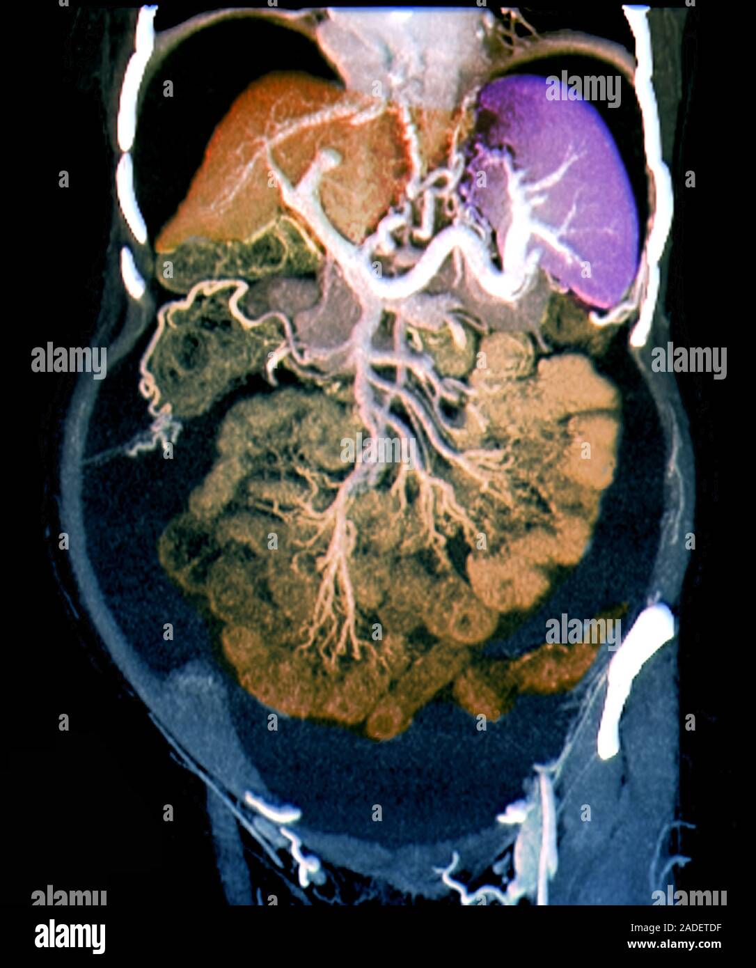 Swollen abdomen in cirrhosis. Coloured computed tomography (CT) scan of ...