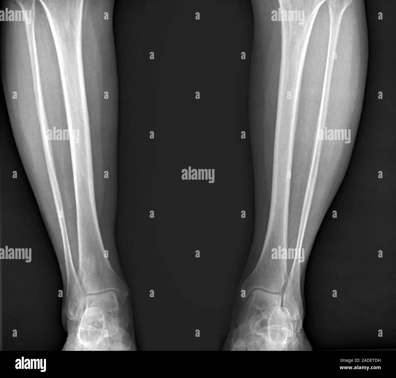 Tibial deviation. X-ray of the lower legs of a 64-year-old patient with ...