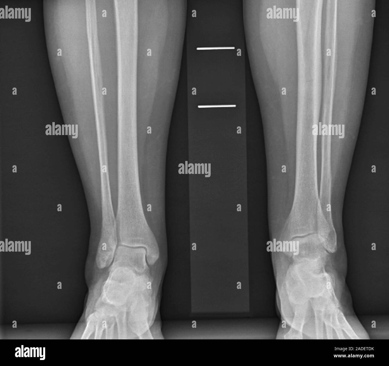 Tibial deviation. Coloured X-ray of the lower legs of a 54-year-old ...