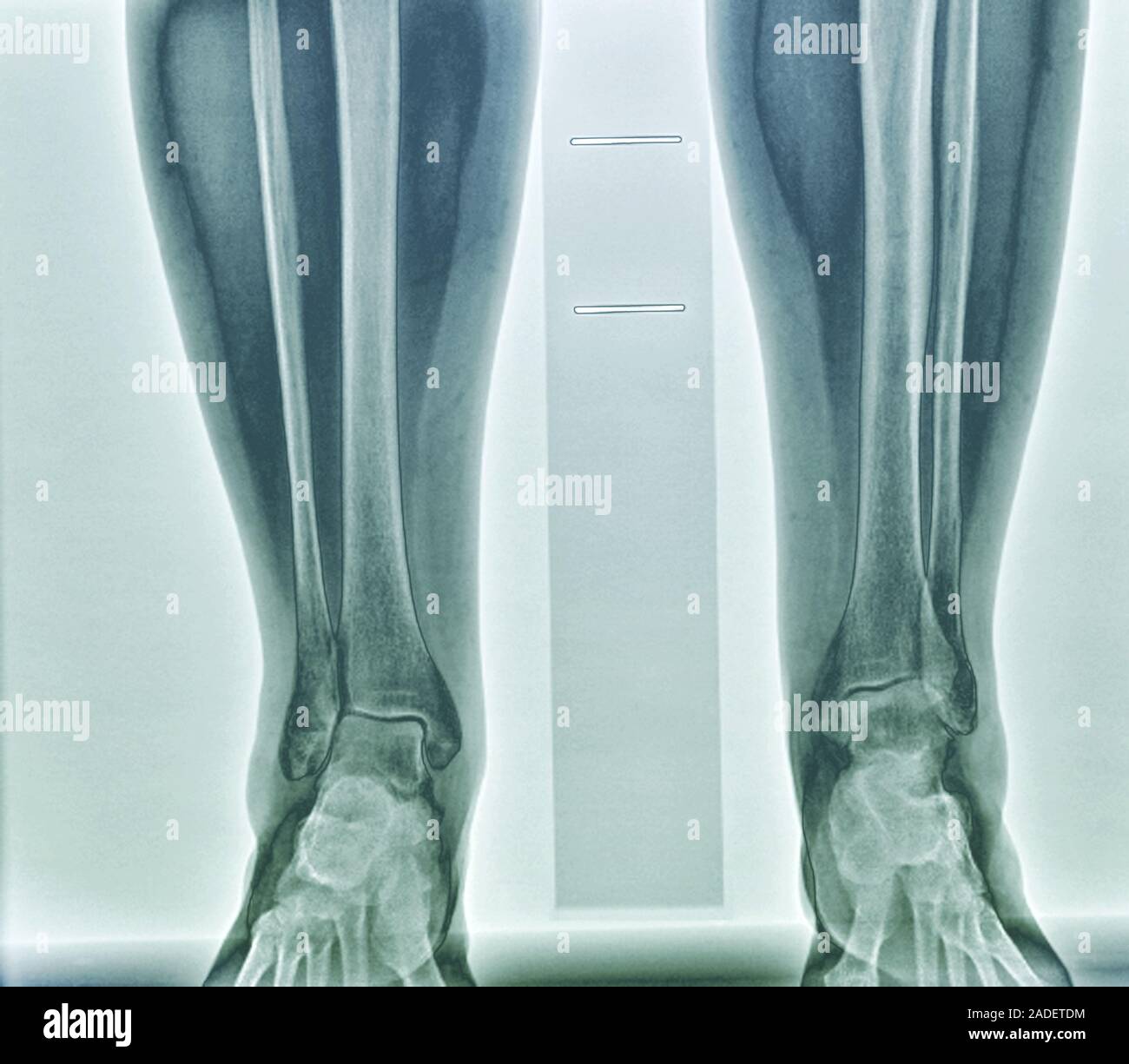 Tibial deviation. Coloured X-ray of the lower legs of a 54-year-old ...