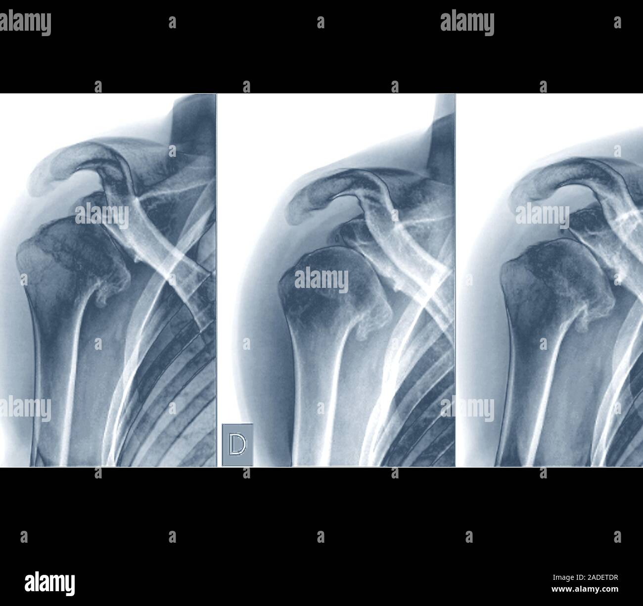 Complications following dislocated shoulder in sports injury. Coloured ...