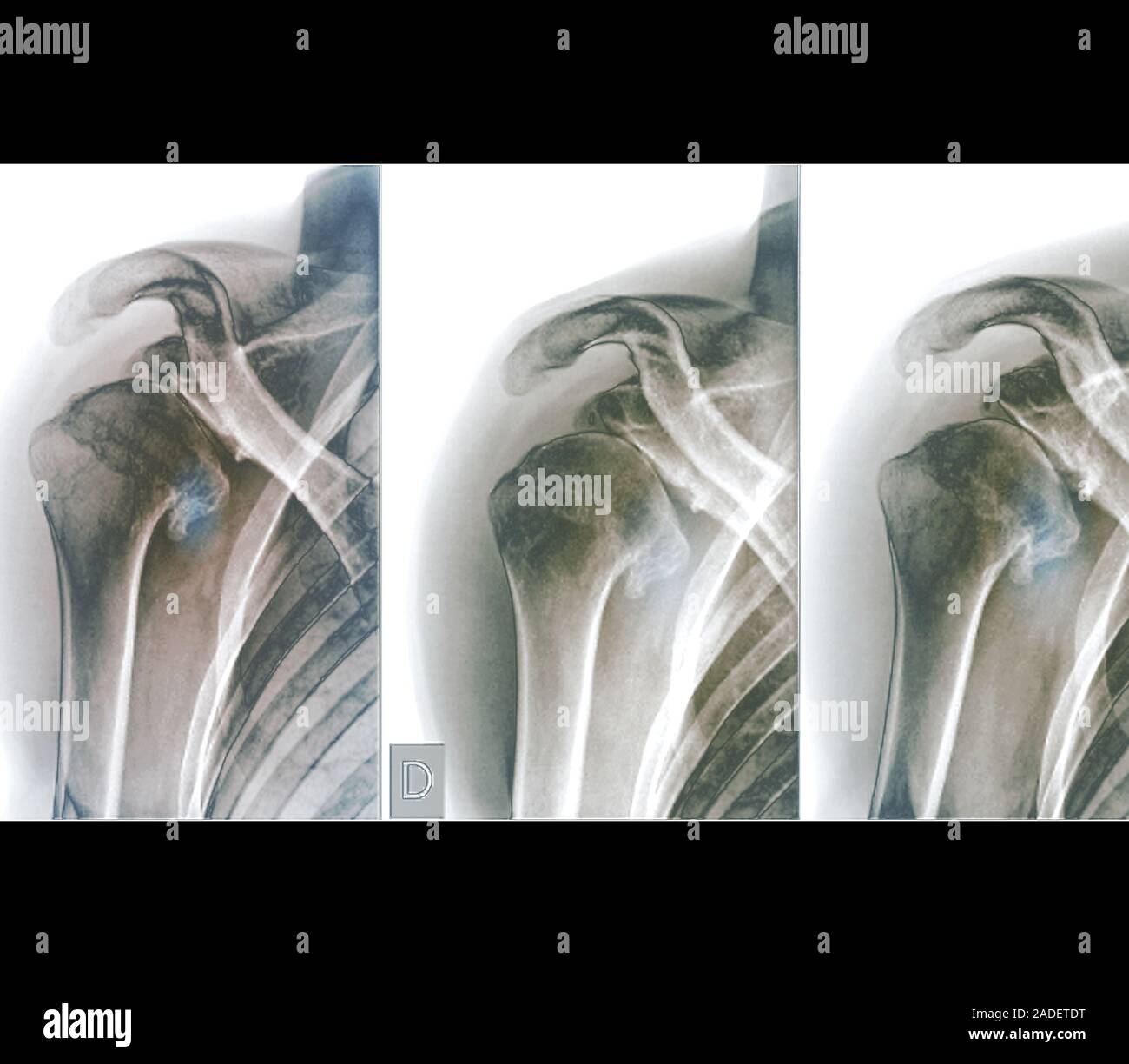 Complications following dislocated shoulder in sports injury. Coloured ...