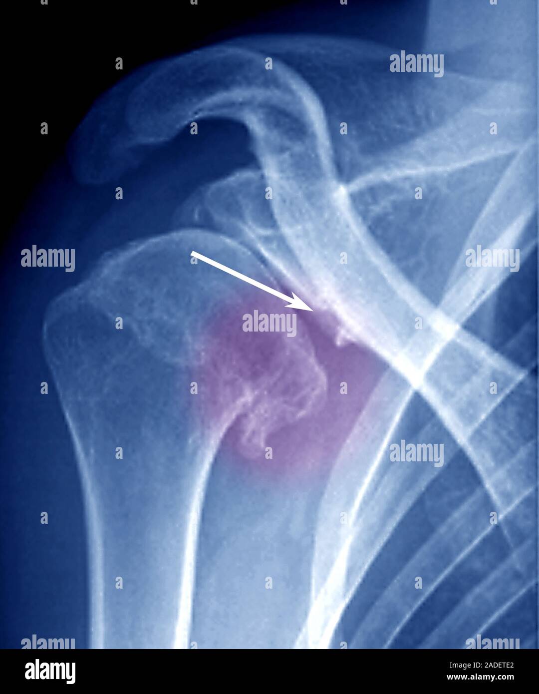 Complications following dislocated shoulder in sports injury. X-ray of ...