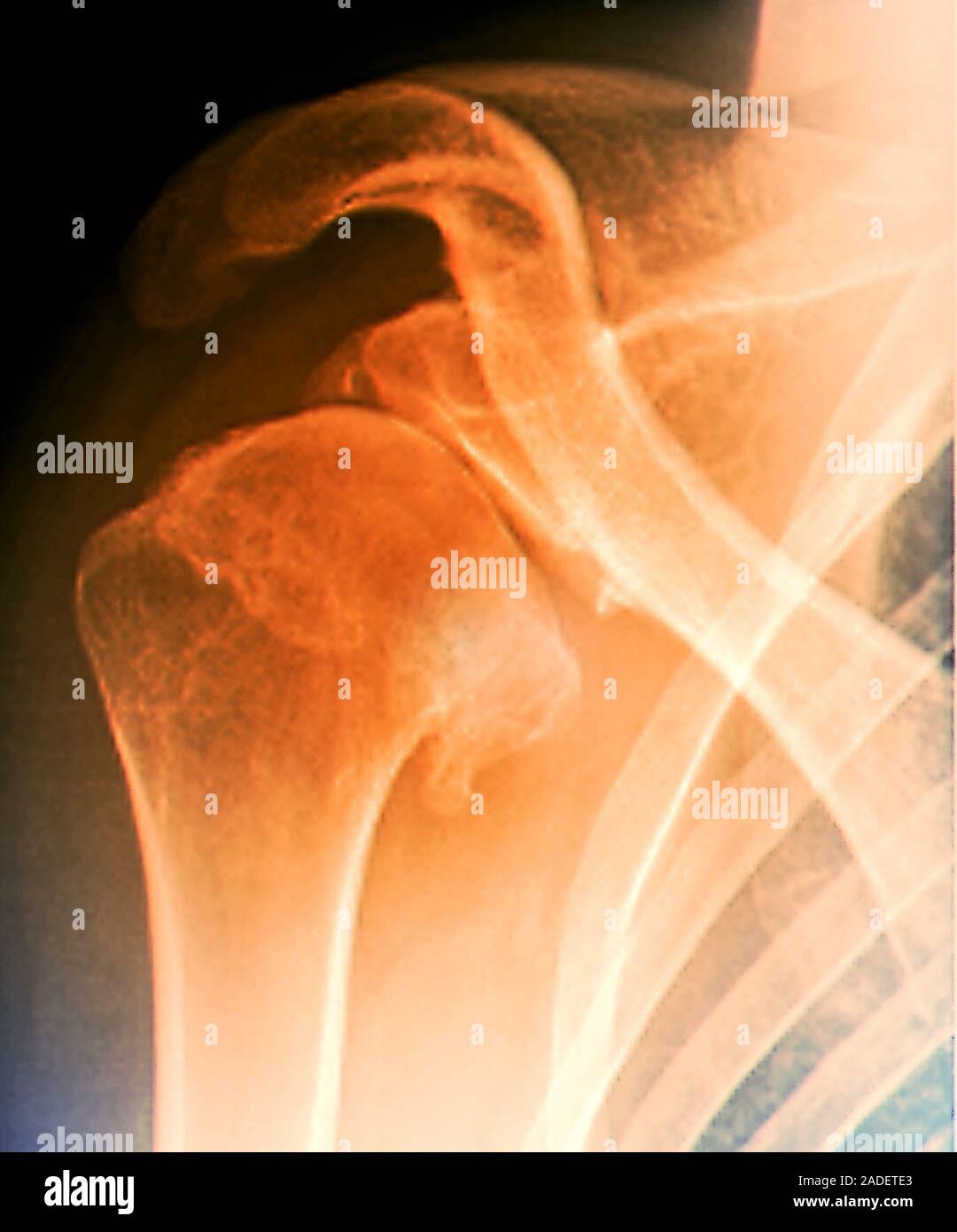 Complications following dislocated shoulder in sports injury. X-ray of ...