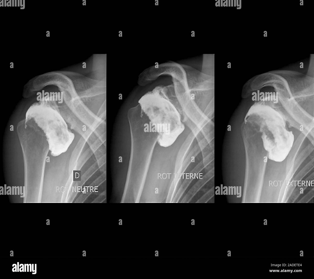 Complications following dislocated shoulder in sports injury. X-rays of ...