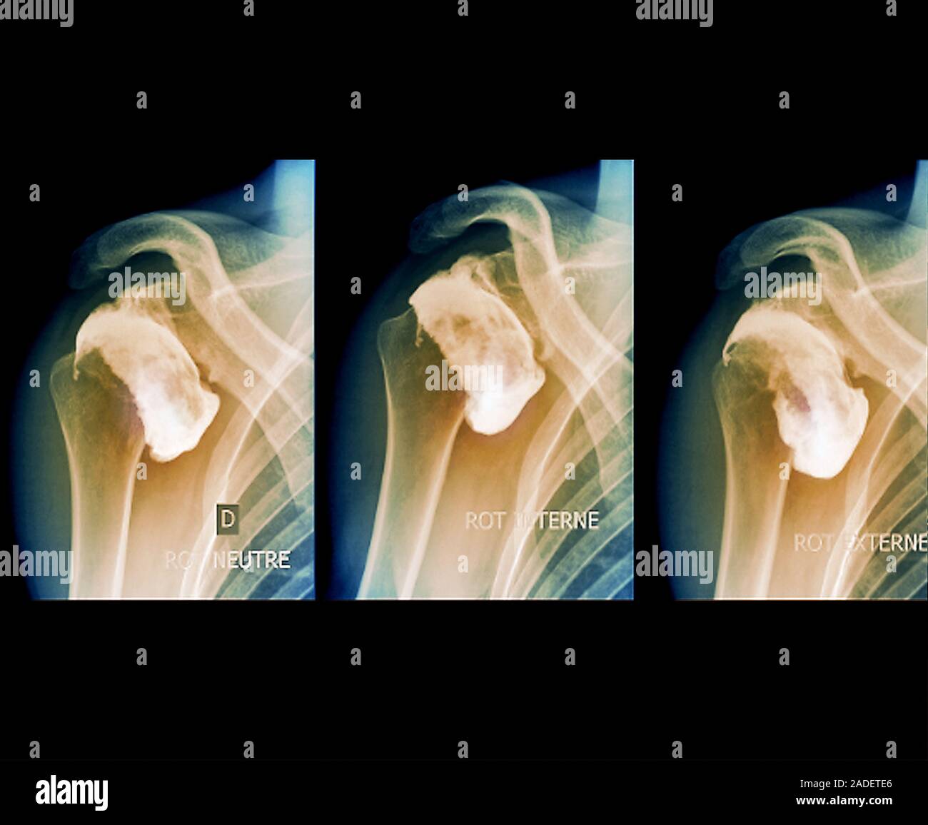 Complications following dislocated shoulder in sports injury. X-rays of ...