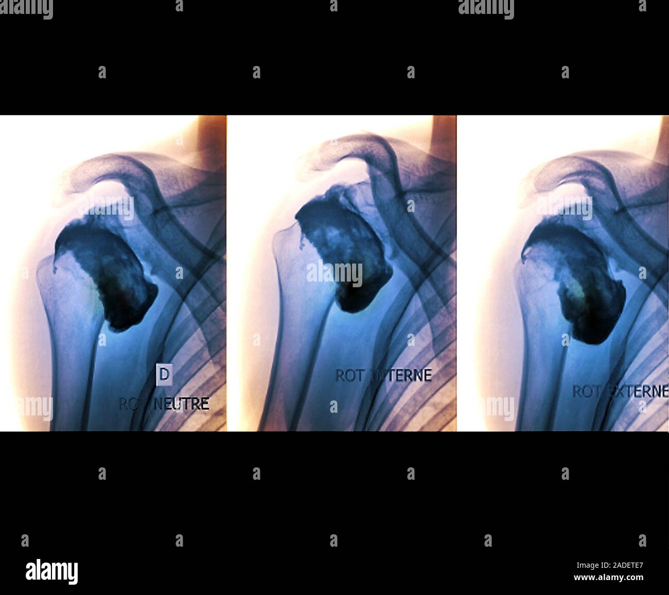 Complications following dislocated shoulder in sports injury. X-rays of ...