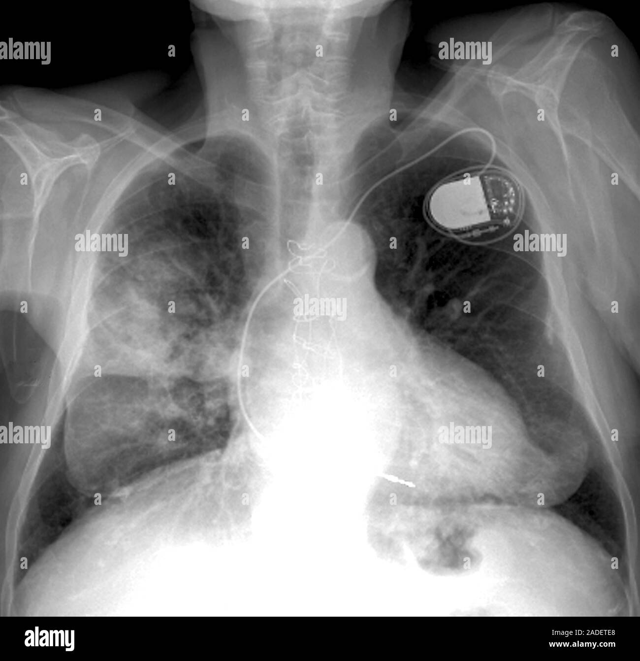 Pacemaker. Chest X-ray showing a pacemaker (upper right) in a 75-year ...
