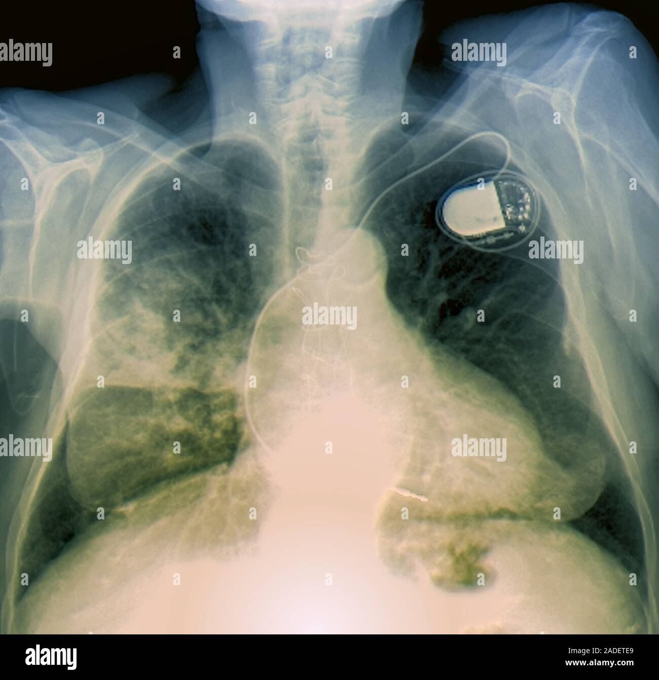 Pacemaker. Chest X-ray showing a pacemaker (upper right) in a 75-year ...