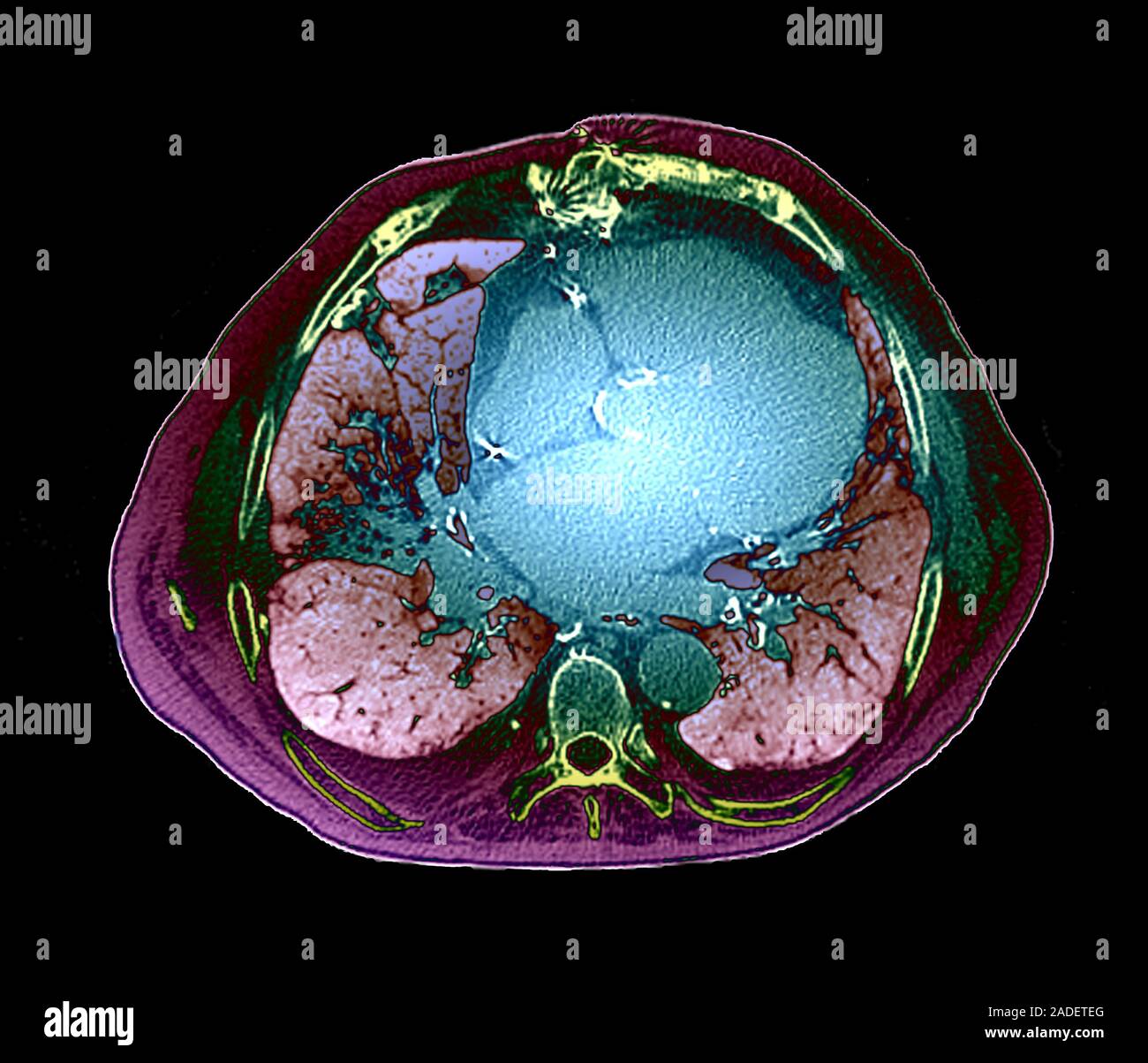 Cardiac decompensation. Coloured computed tomography (CT) scan of an axial section through the ...
