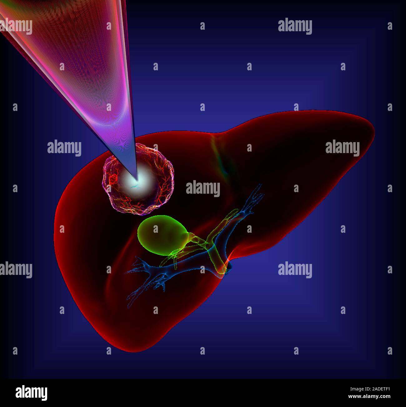 Liver cancer radiotherapy. Illustration of radiotherapy for treatment ...