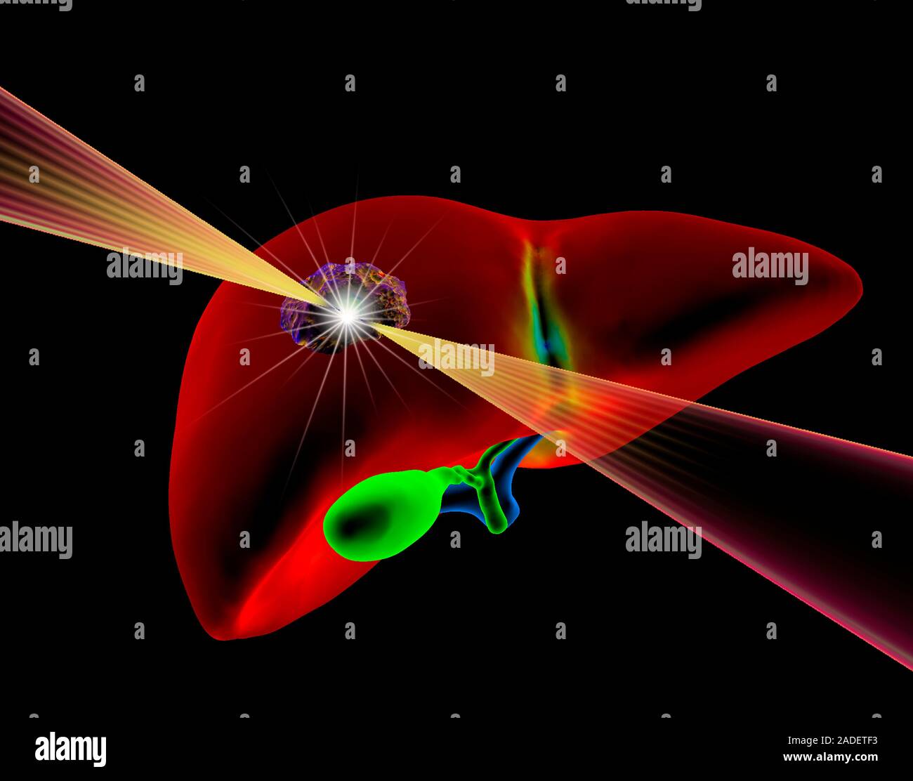 Liver cancer radiotherapy. Illustration of radiotherapy for treatment ...