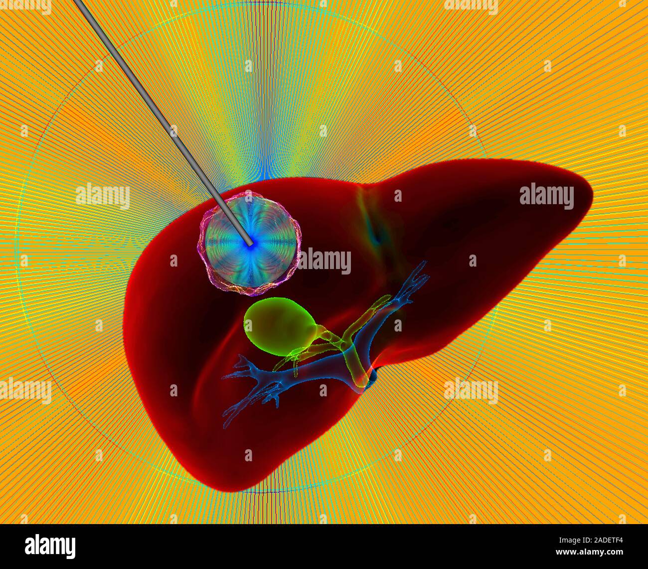 Liver cancer thermal ablation. Illustration of radiofrequency or microwave ablation for ...