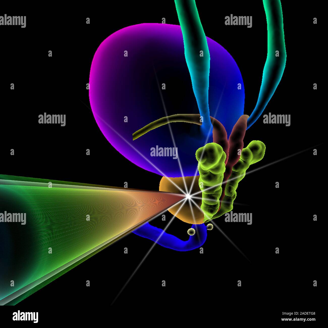 Prostate cancer radiotherapy. Illustration of radiotherapy for ...