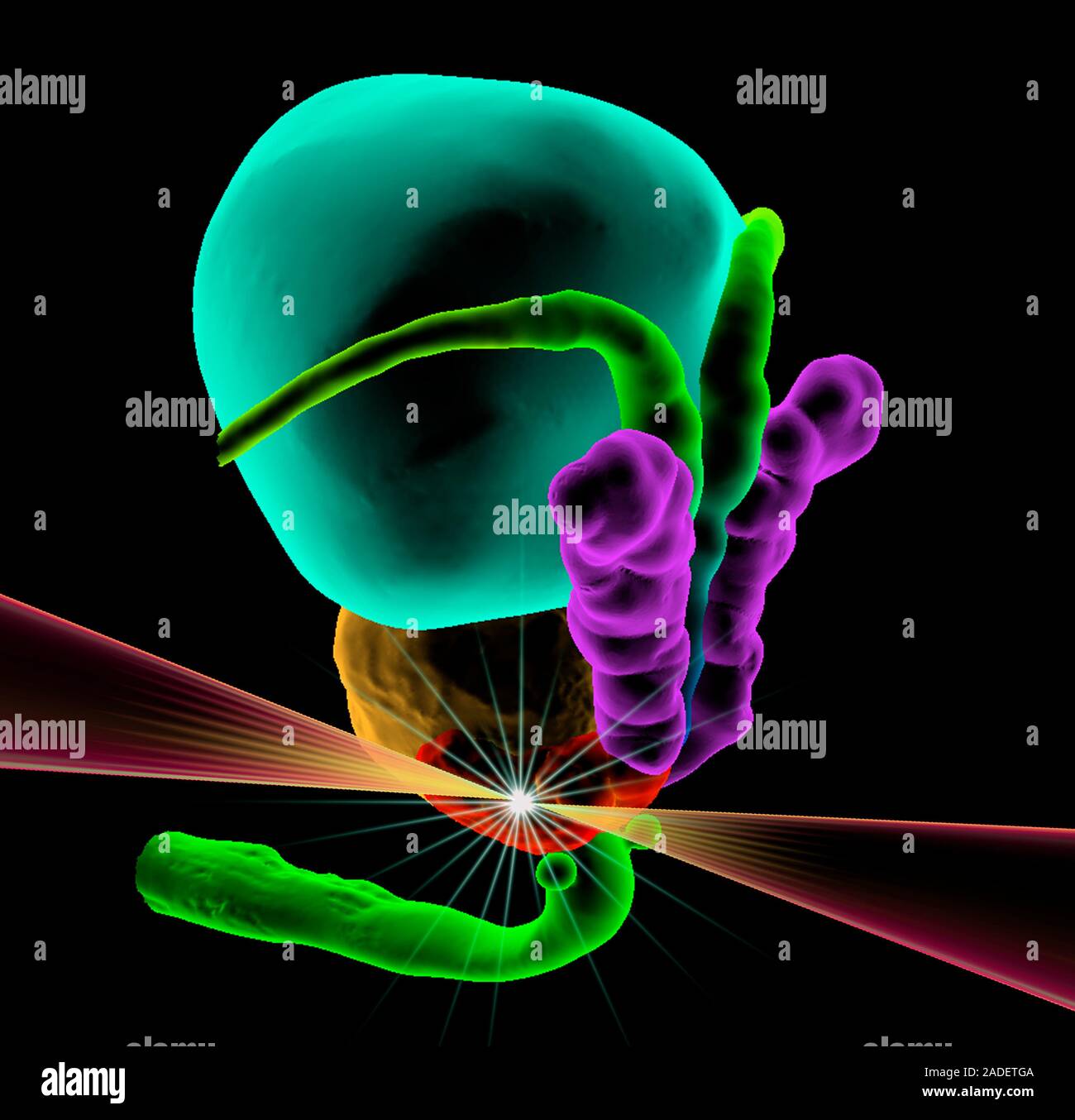 Prostate cancer radiotherapy. Illustration of radiotherapy for ...