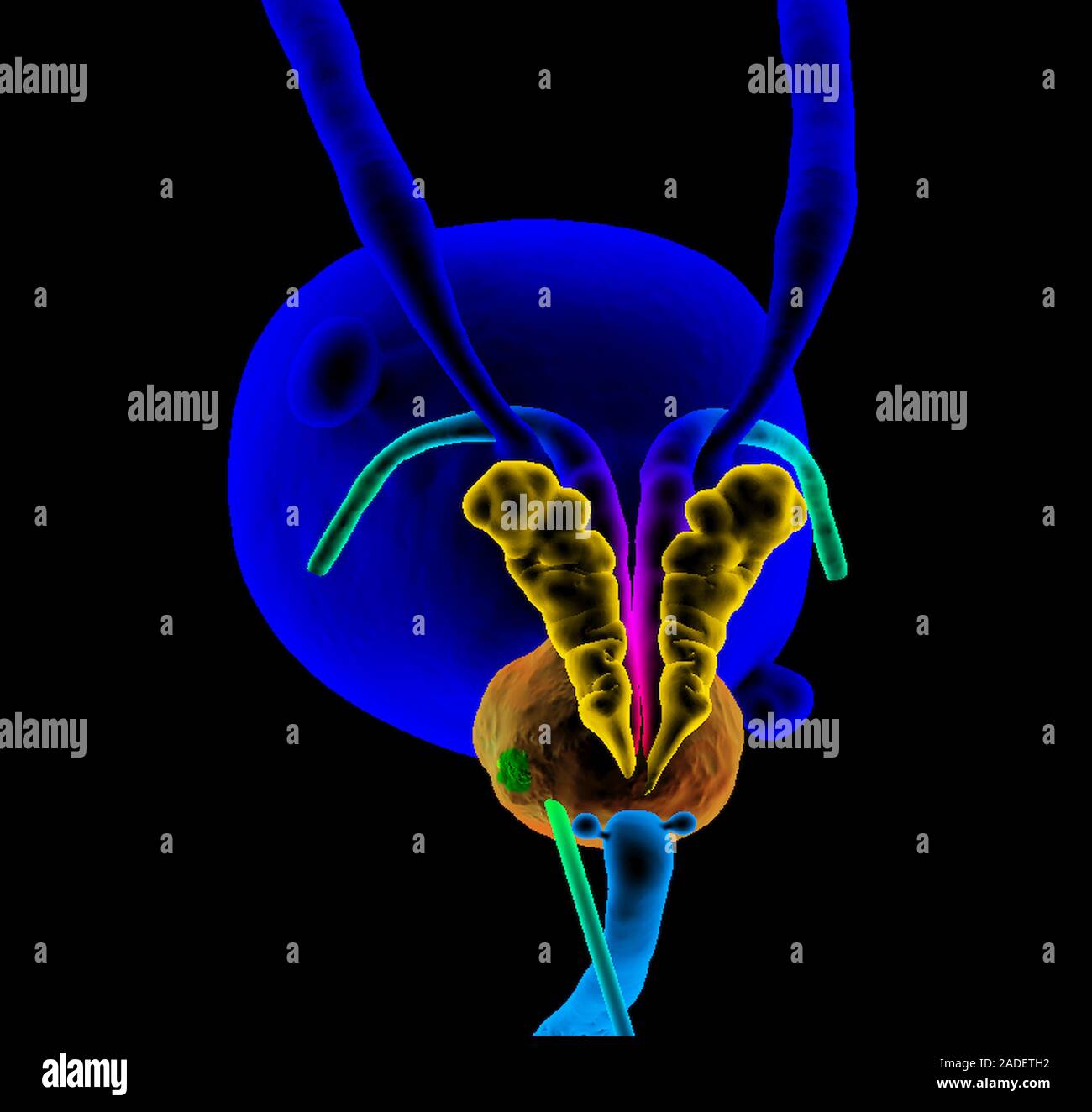 Prostate needle biopsy. Illustration of a needle biopsy being performed ...
