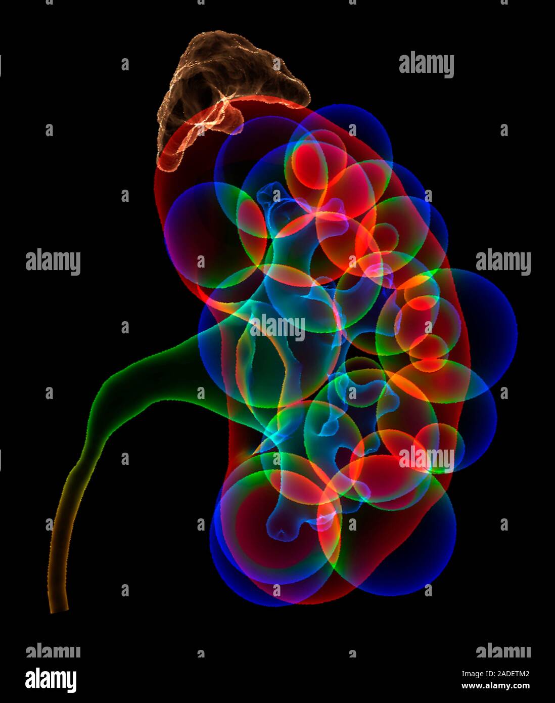 Polycystic kidney. Illustration of a kidney (semi-transparent view ...