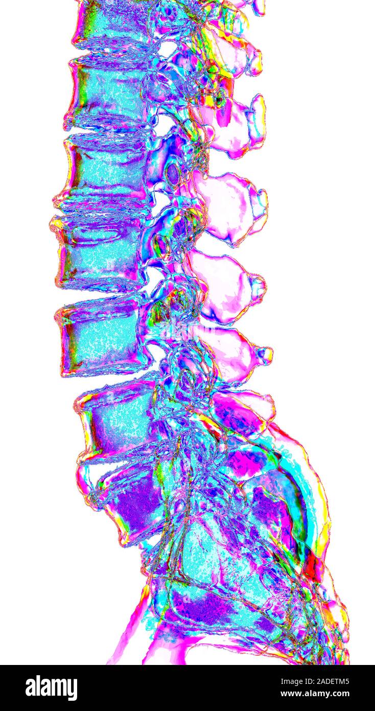 Spinal degeneration. Coloured 3D lateral computed tomography (CT) scan ...