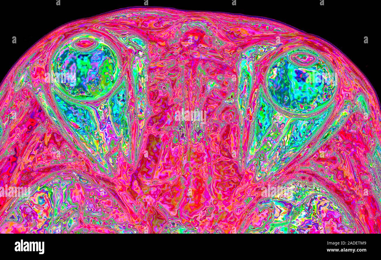 Human eyes and optic nerves. Coloured axial magnetic resonance imaging ...
