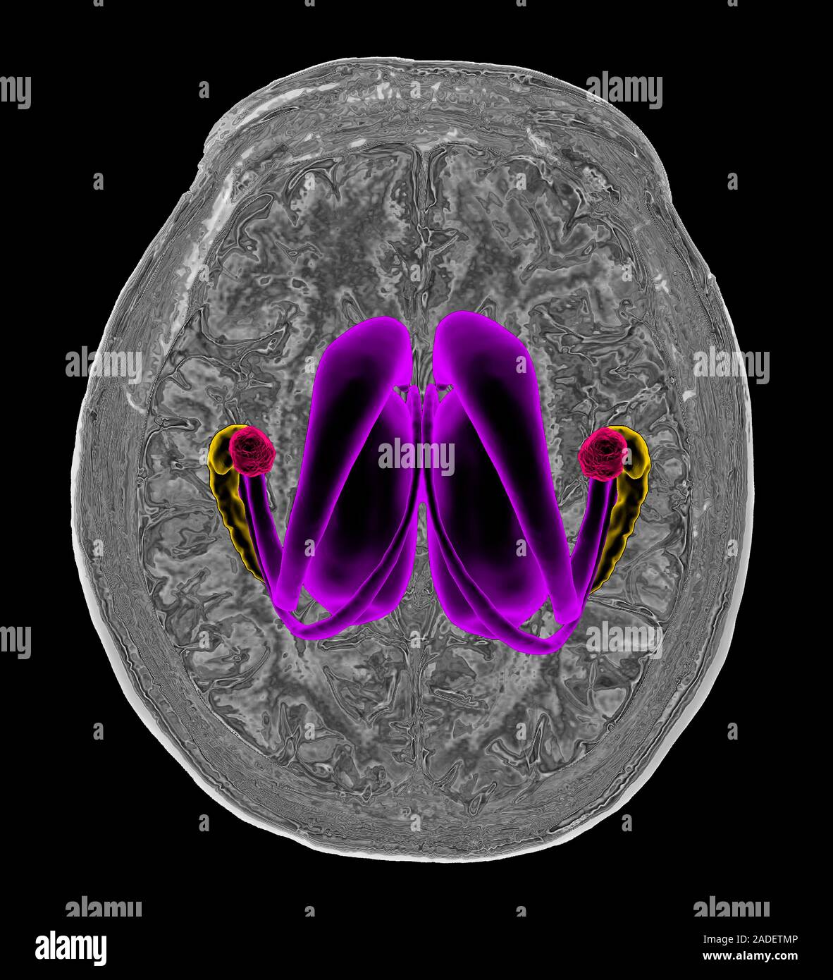 Human brain and limbic system, MRI-based illustration. The limbic ...