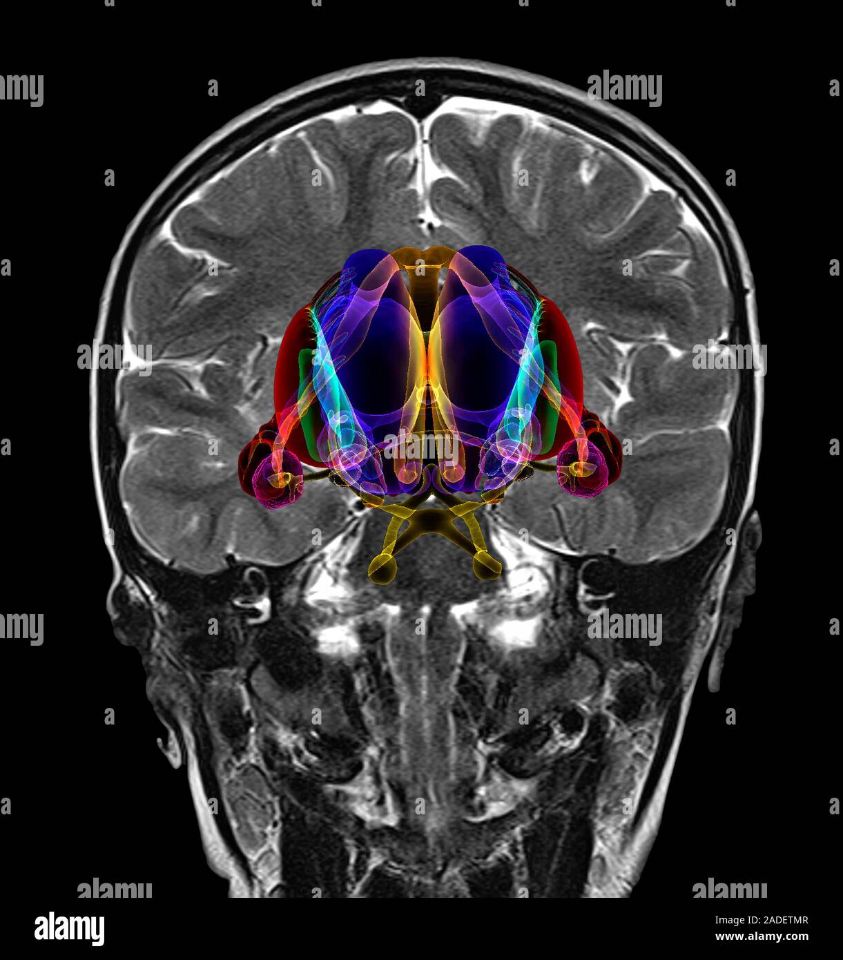 Human brain and limbic system, MRI-based illustration. The limbic ...