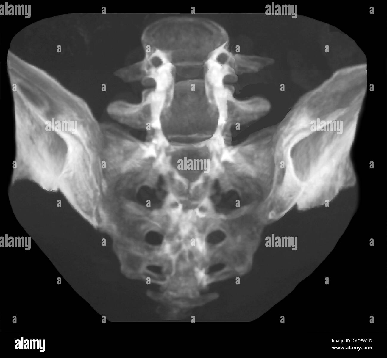 Sacrum following laminectomy. Composite 2D and 3D frontal computed ...