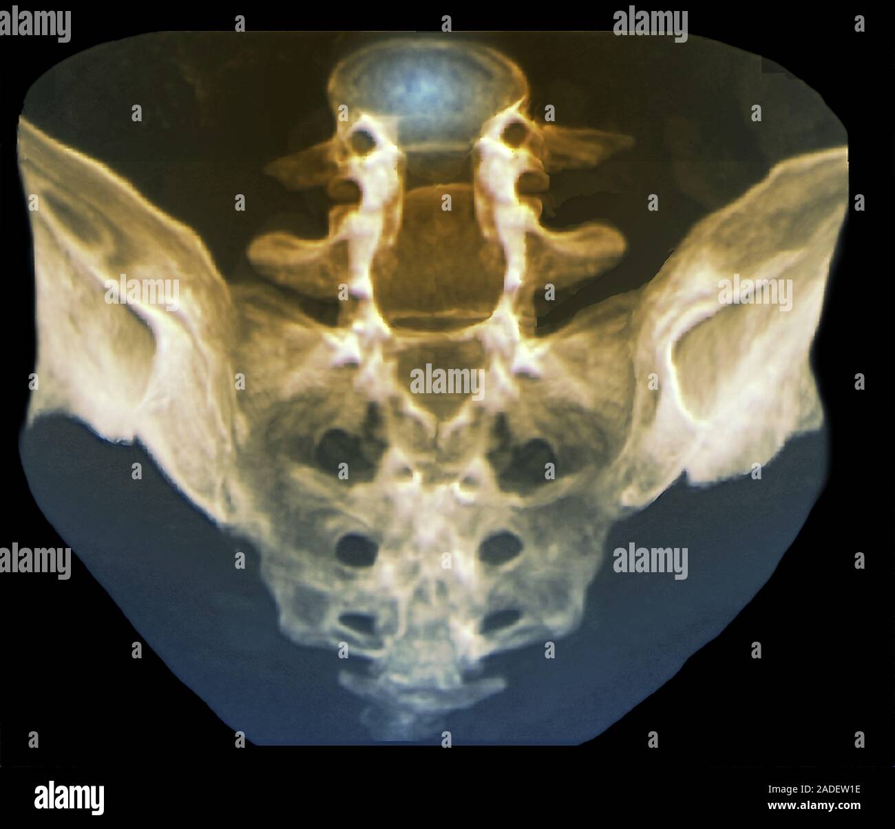 Sacrum following laminectomy. Coloured composite 2D and 3D frontal ...