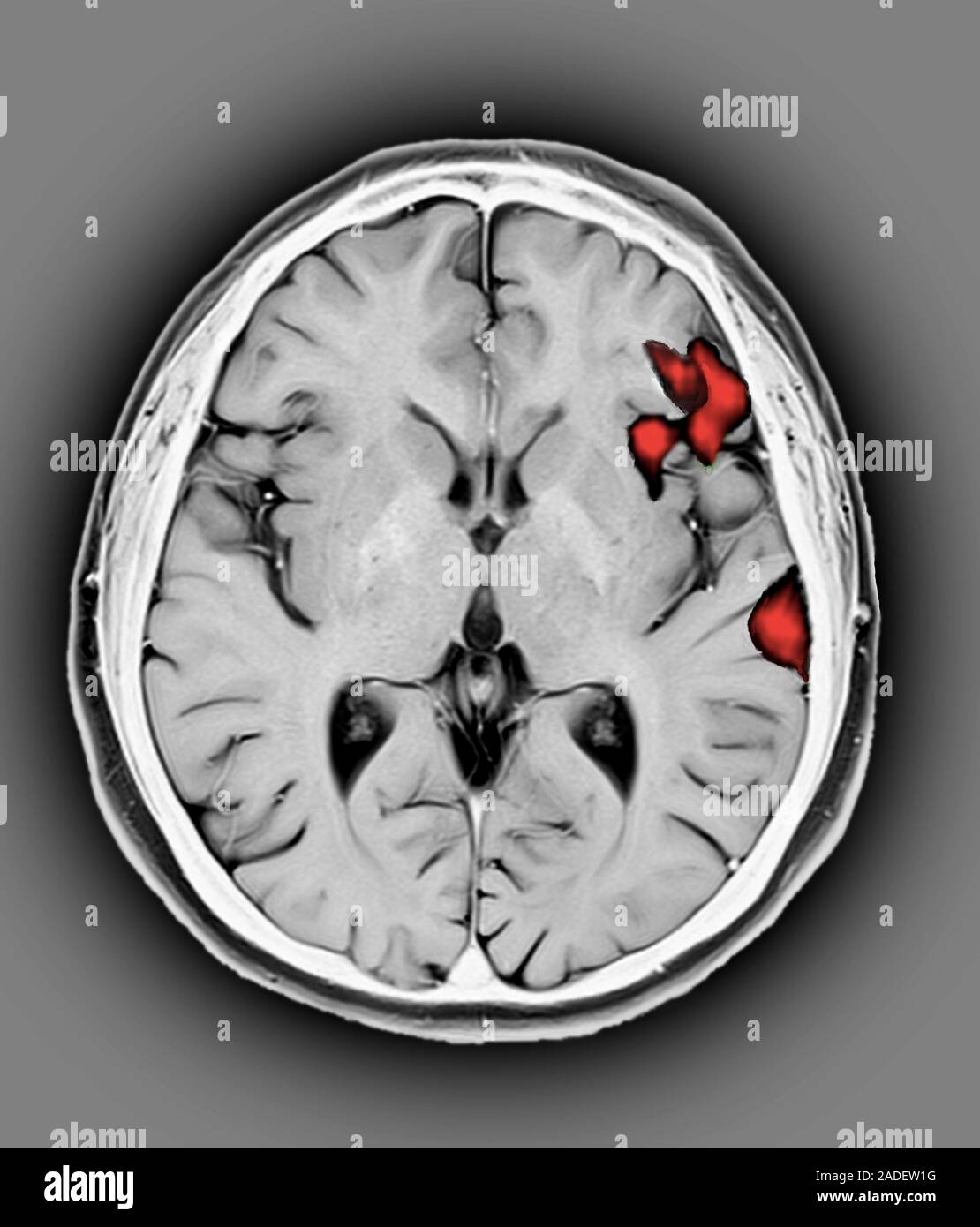 Brain activity in speech production. Coloured functional magnetic ...