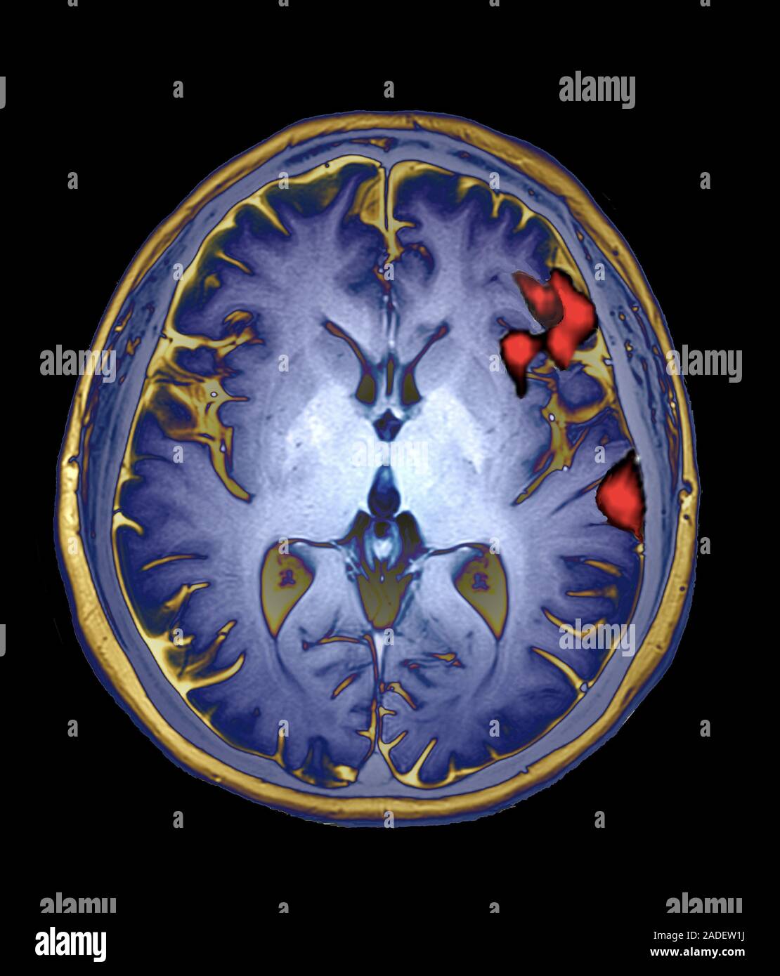 Brain activity in speech production. Coloured functional magnetic ...