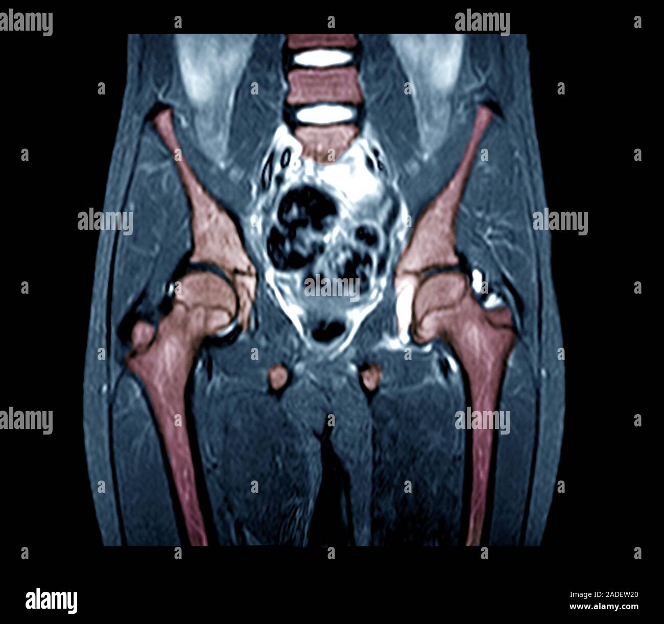 Hip inflammation. Coloured magnetic resonance imaging (MRI) scan of the ...