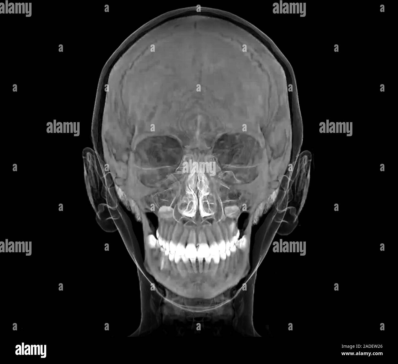 Normal human skull. 3D computed tomography (CT) scan of the head of a ...