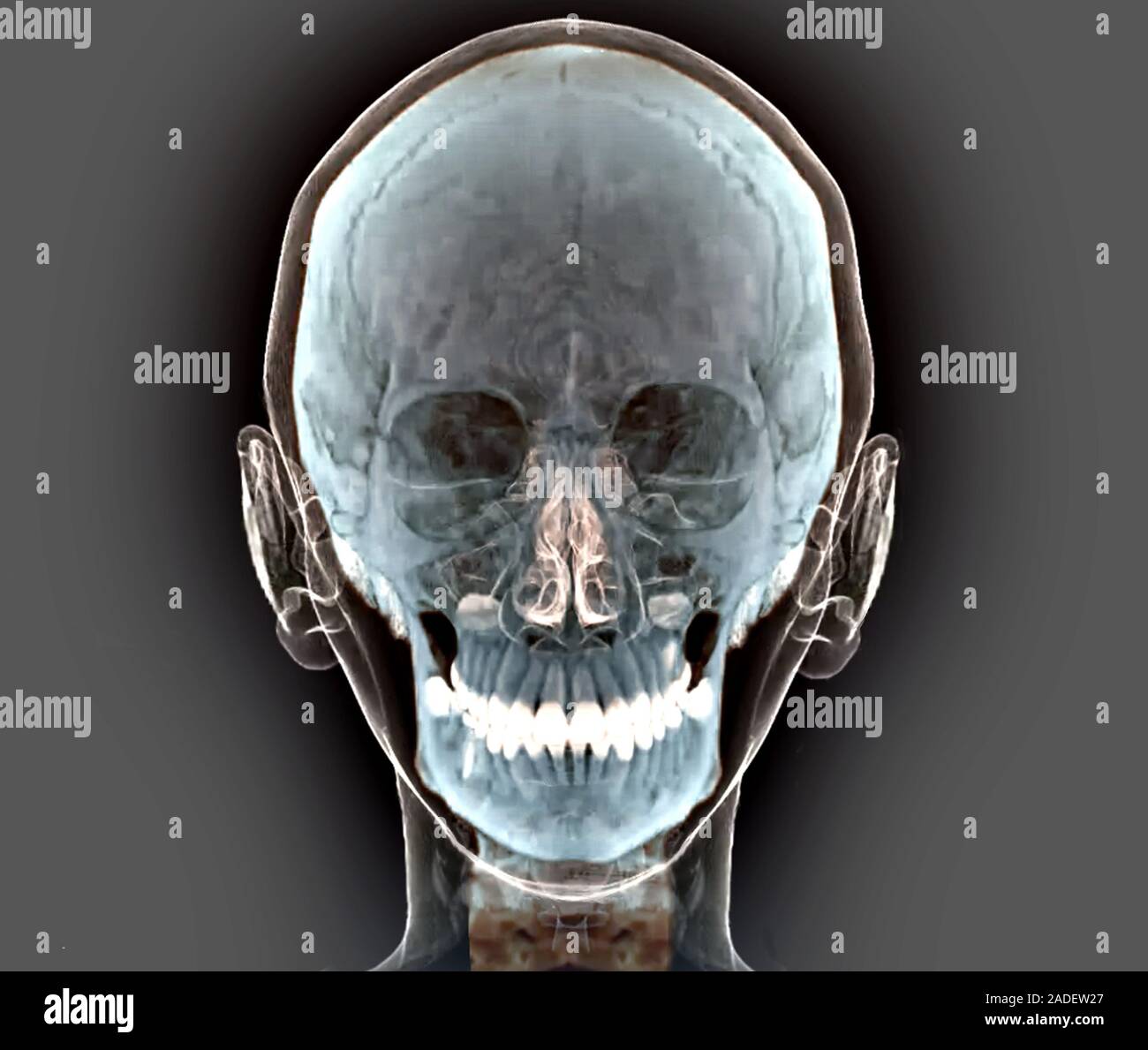 Normal human skull. Coloured 3D computed tomography (CT) scan of the ...