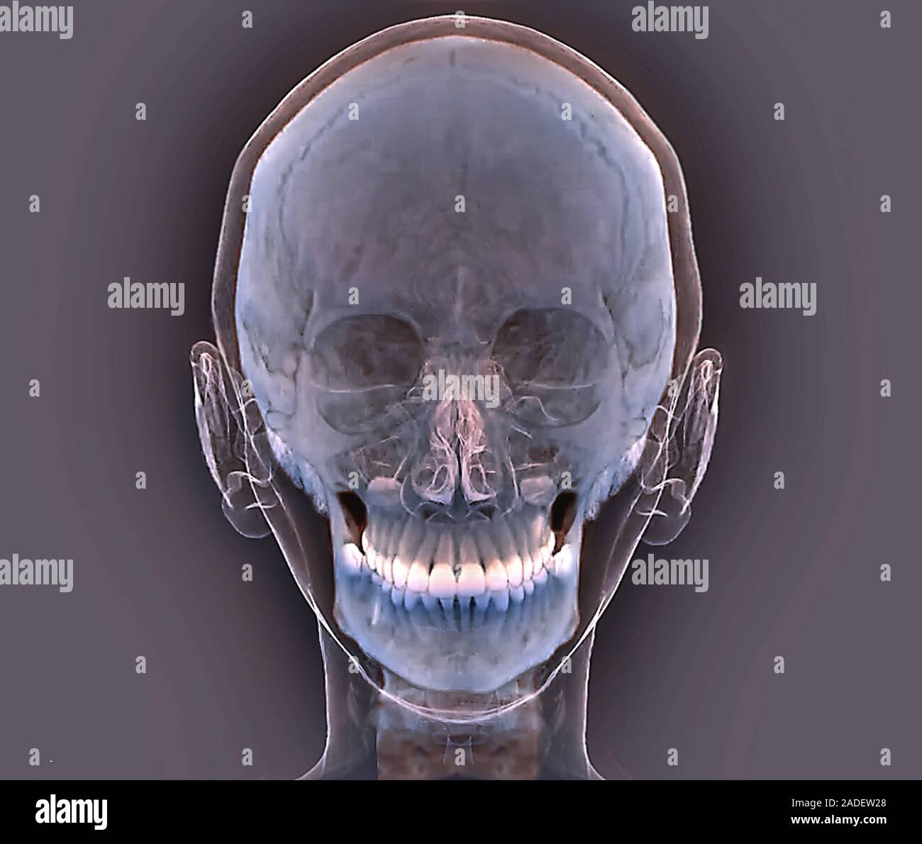 Normal human skull. Coloured 3D computed tomography (CT) scan of the ...