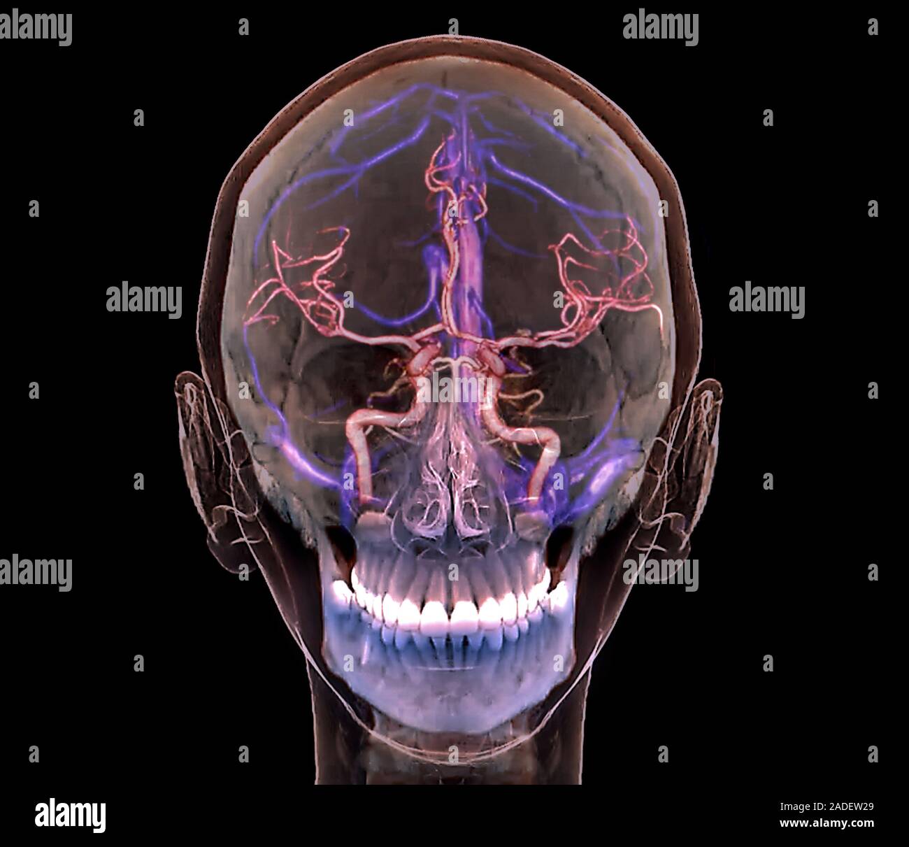 Normal brain blood supply. Coloured 3D computed tomography (CT) angiogram of the head of a 23 ...