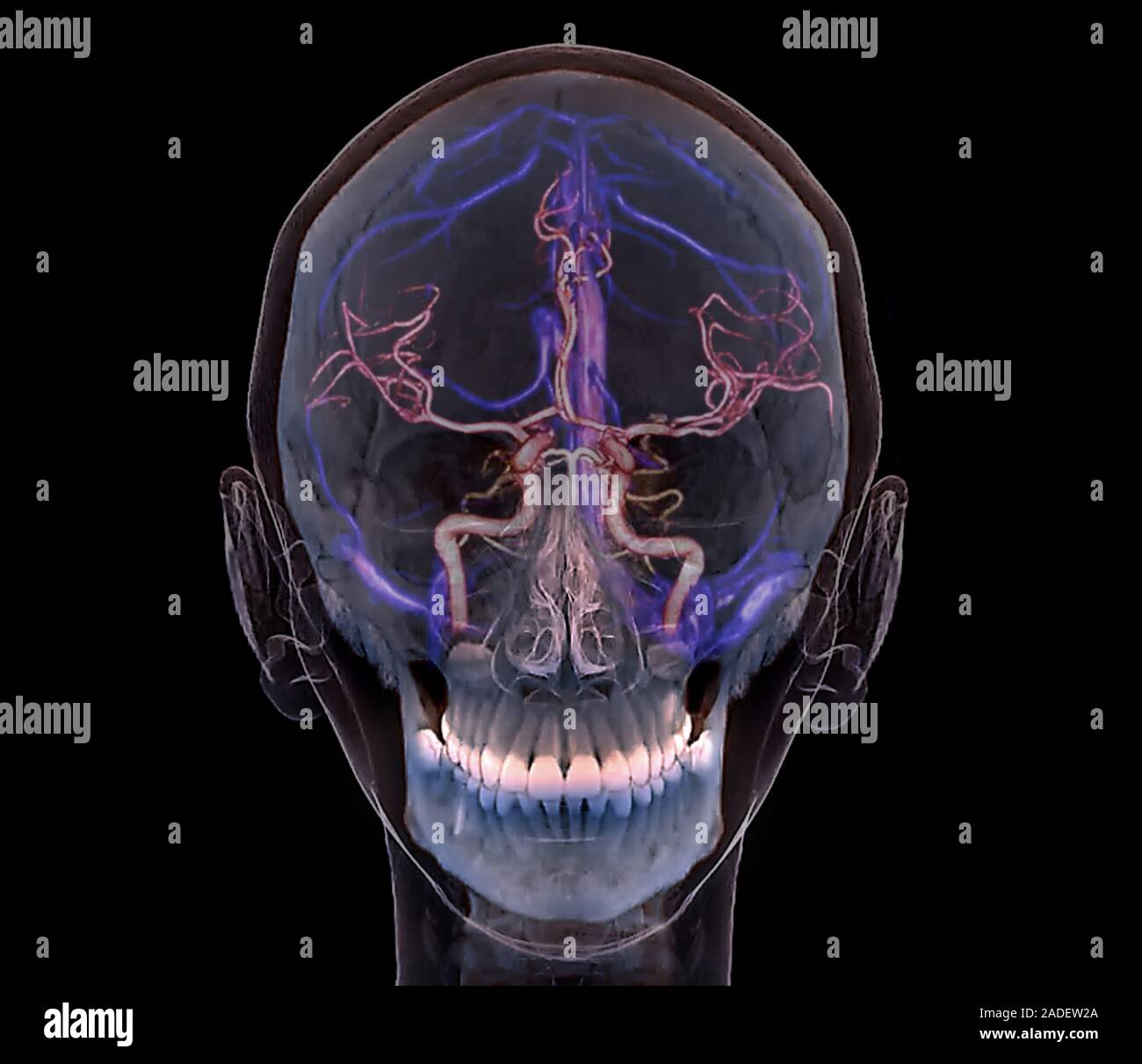 Normal brain blood supply. Coloured 3D computed tomography (CT ...