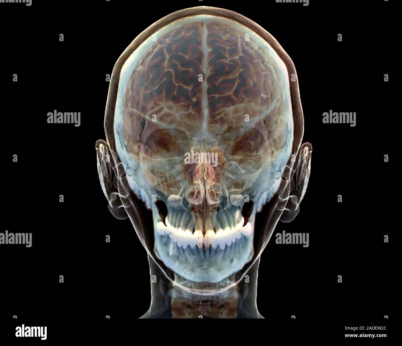 Normal human brain. Coloured 3D computed tomography (CT) scan of the head of a 23-year-old ...