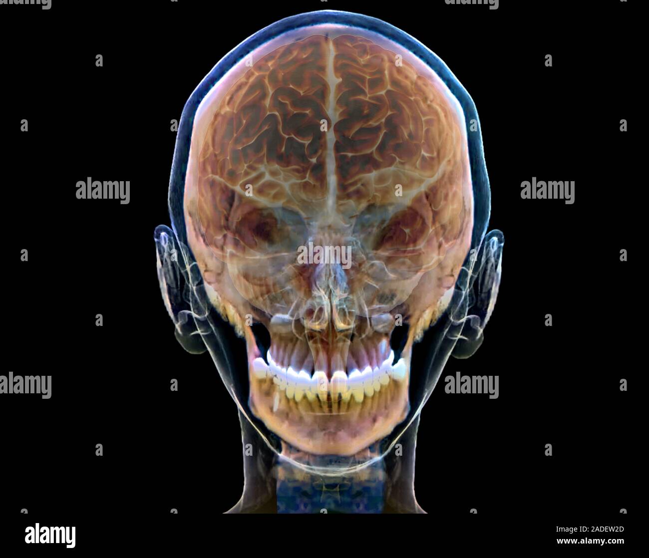 Normal human brain. Coloured 3D computed tomography (CT) scan of the ...
