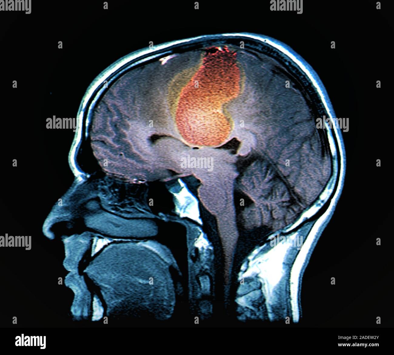 Brain cancer. Coloured magnetic resonance imaging (MRI) scan of a sagittal section through the ...