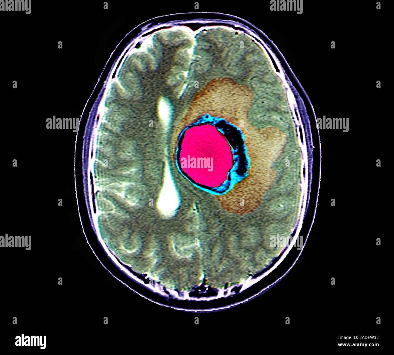 Brain cancer. Magnetic resonance imaging (MRI) scan of an axial section ...