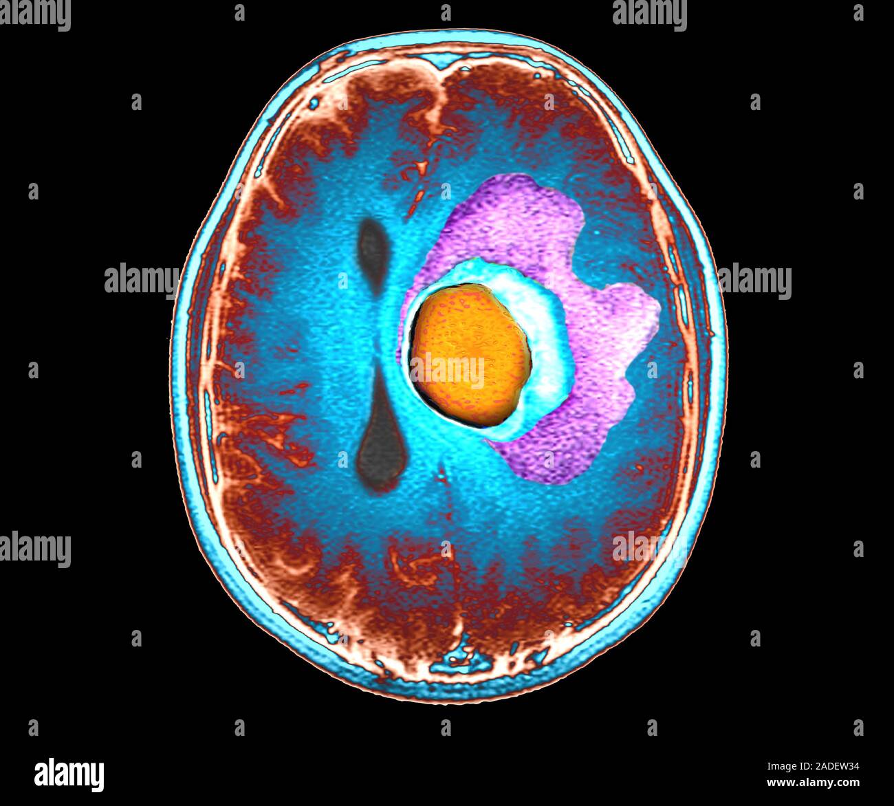 Brain cancer. Magnetic resonance imaging (MRI) scan of an axial section ...