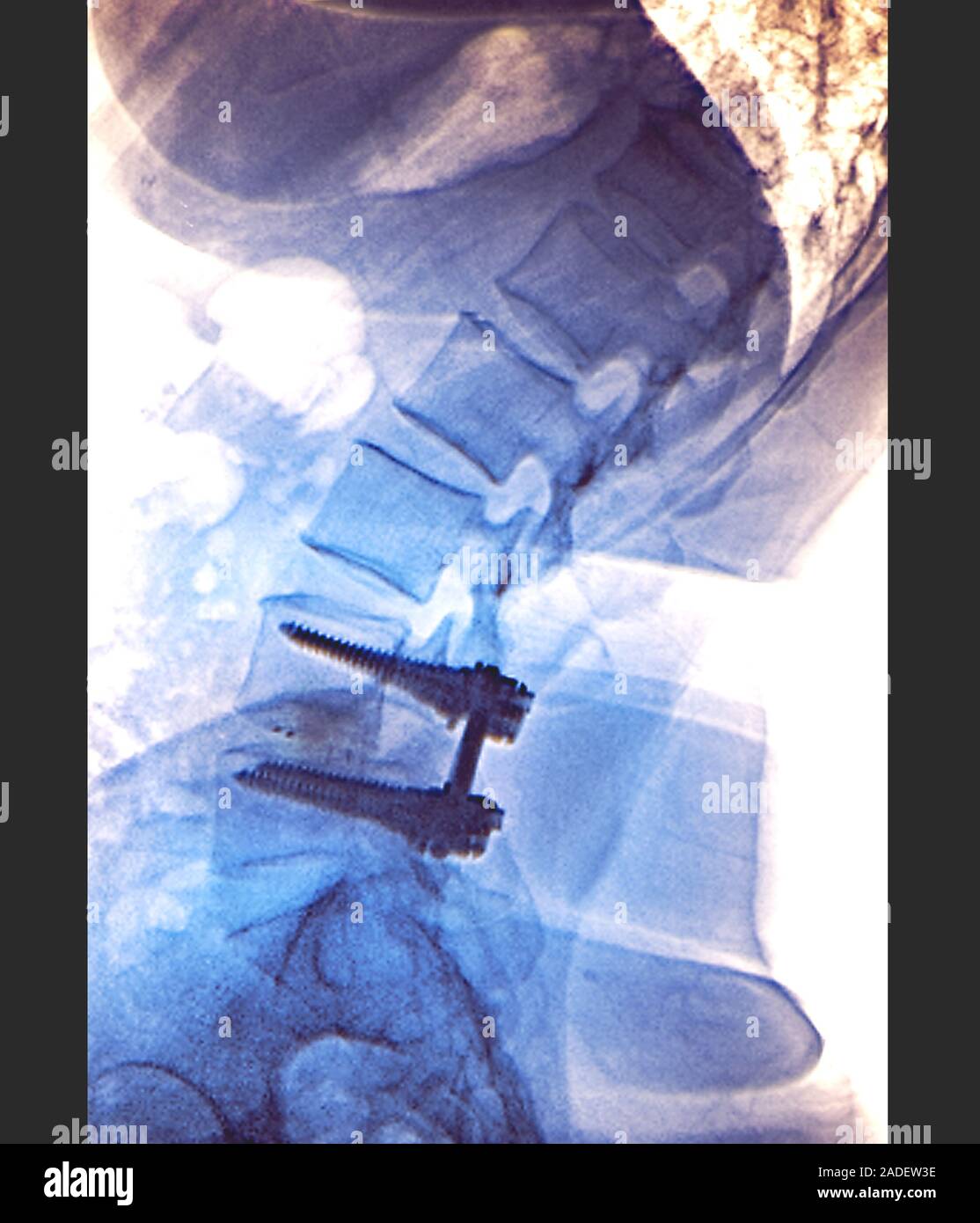 Treatment of spinal disc herniation. Coloured X-ray of a section ...