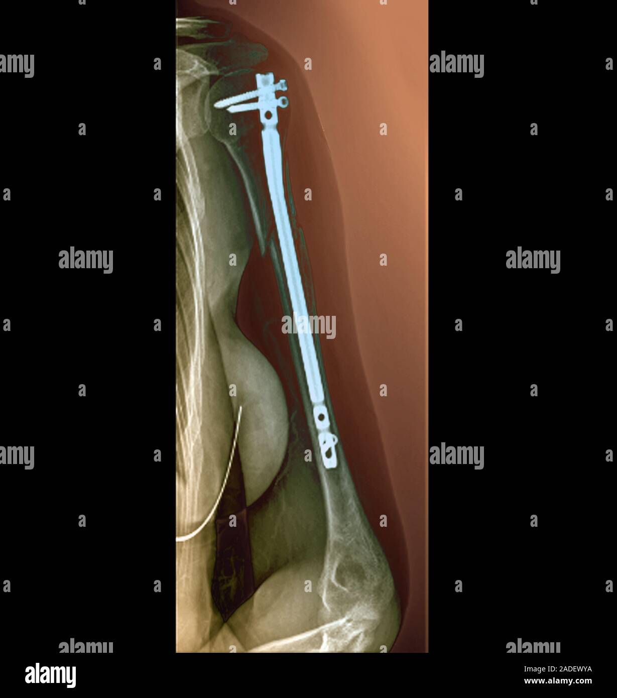 Fixed upper arm fracture. Coloured x-ray of a section through the left ...