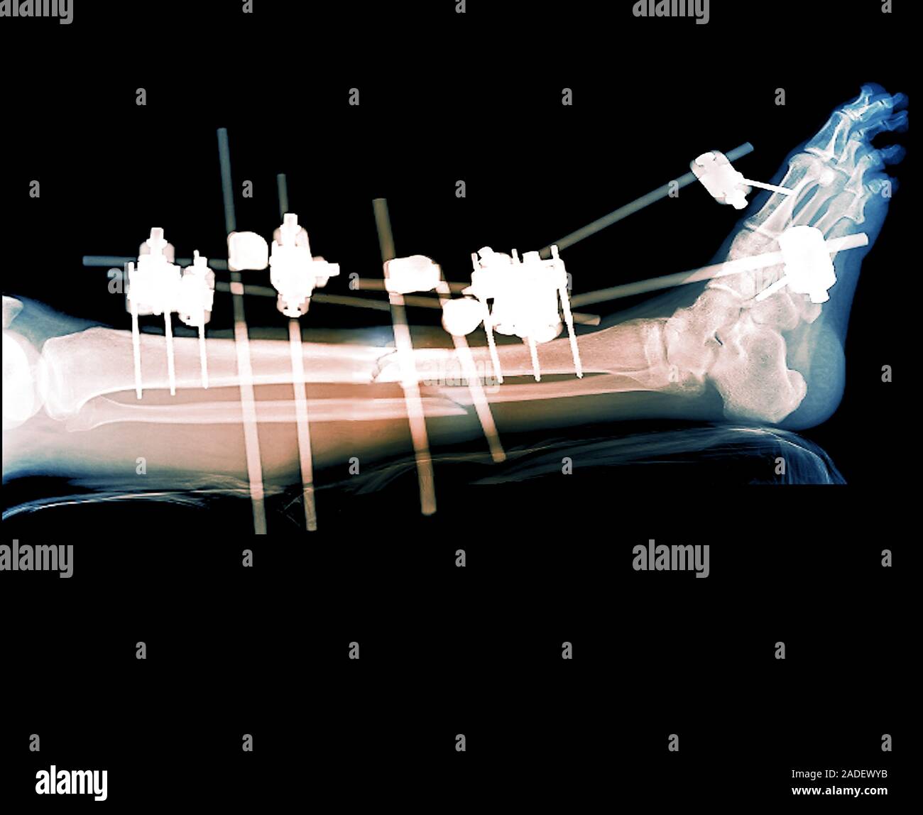 Pinned fractured lower leg bones. Coloured x-ray of the right leg of a ...