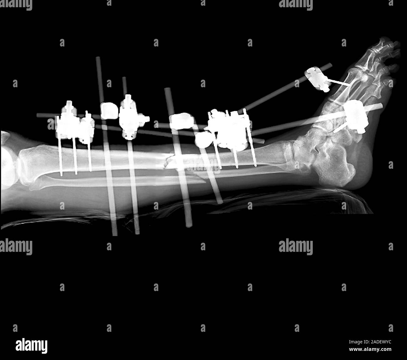 Pinned fractured lower leg bones. X-ray of the right leg of a 38-year ...
