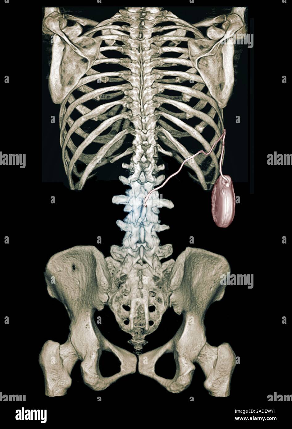 Intrathecal drug delivery. Coloured computed tomography (CT) scan of ...